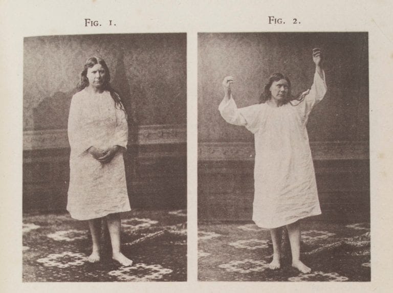 Catalepsy - Hektoen International