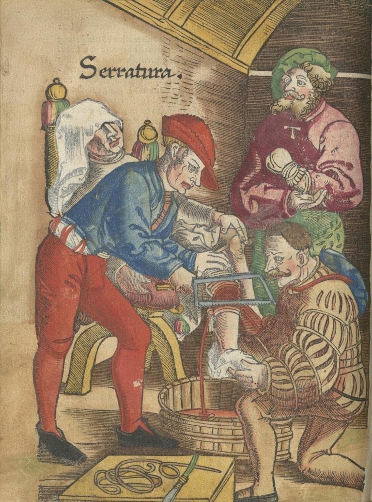 Amputations - Hektoen International