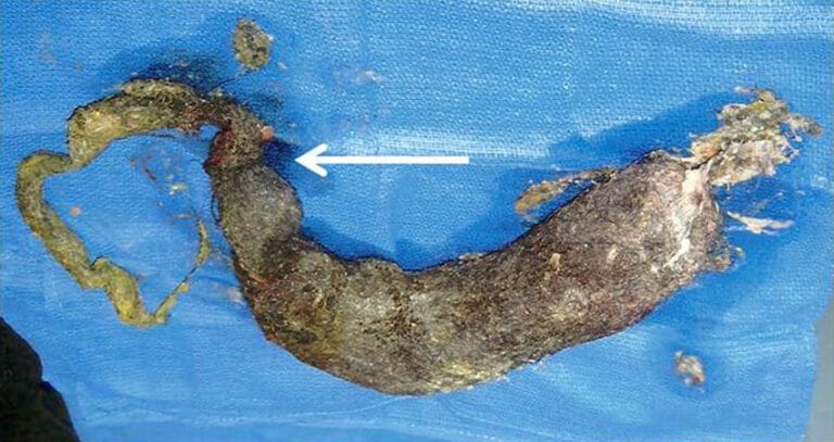 The bizarre history of the bezoar - Hektoen International